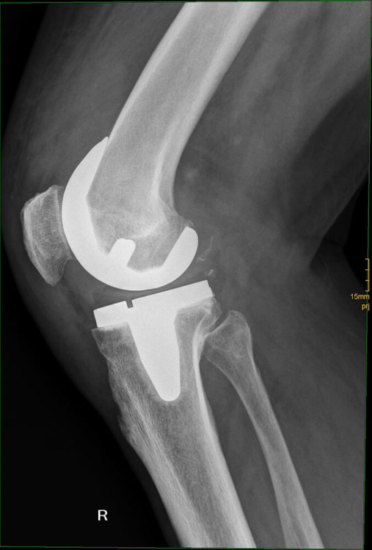 Knorpelschaden, Chondropathie, Arthrose (Knie), Gelenkabnützung ...