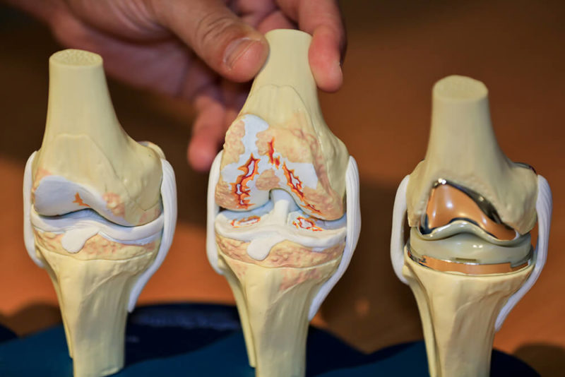 Knorpelschaden, Chondropathie, Arthrose (Knie), Gelenkabnützung ...